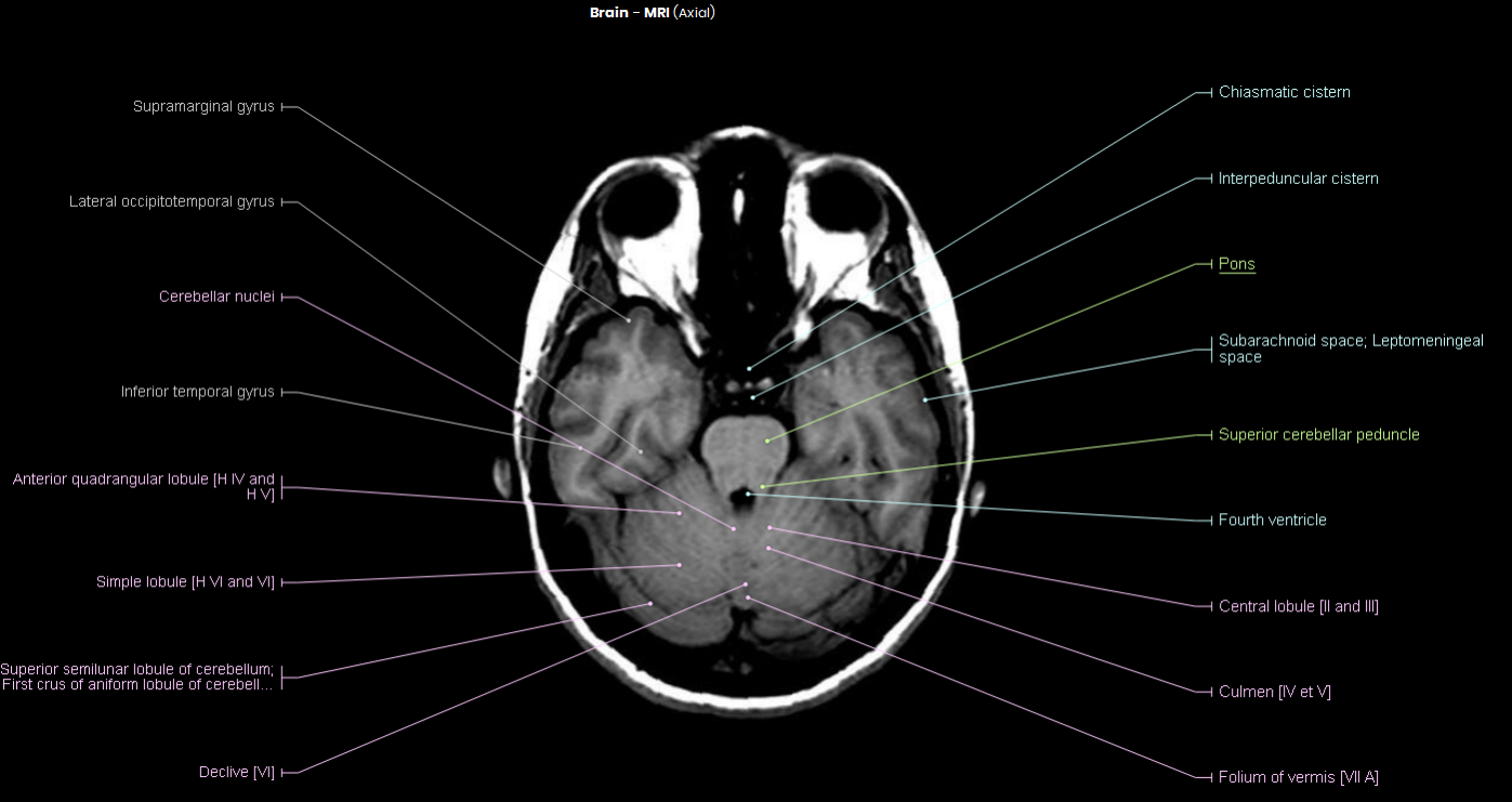 Brain MRI - NeurologyNeeds.com
