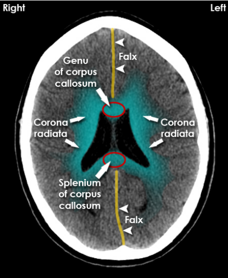 Brain CT - NeurologyNeeds.com