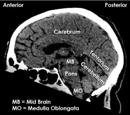 Brain CT - NeurologyNeeds.com