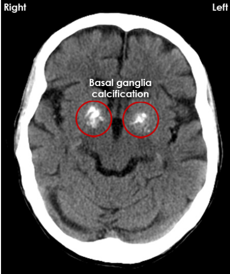 Brain CT - NeurologyNeeds.com