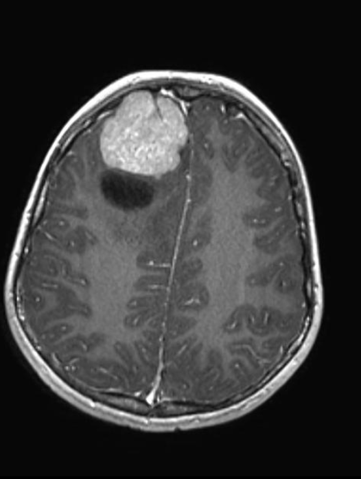 Ependymoma - NeurologyNeeds.com