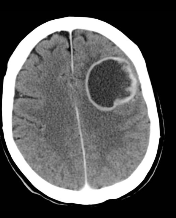 Glioblastoma multiforme - NeurologyNeeds.com