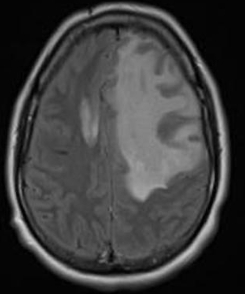 Tumefactive MS - NeurologyNeeds.com