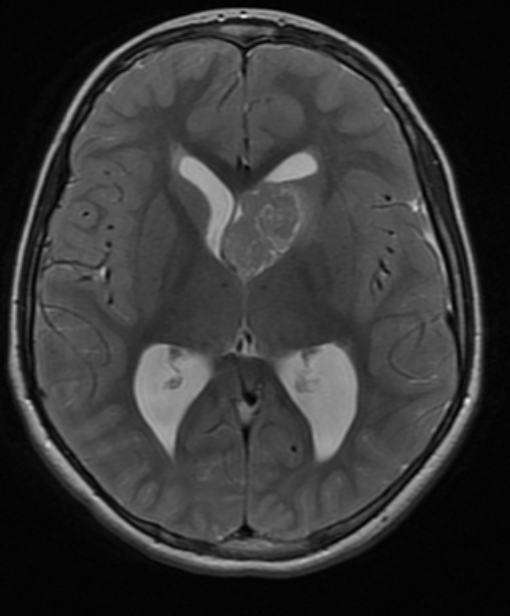 Subependymal Giant Cell Astrocytoma