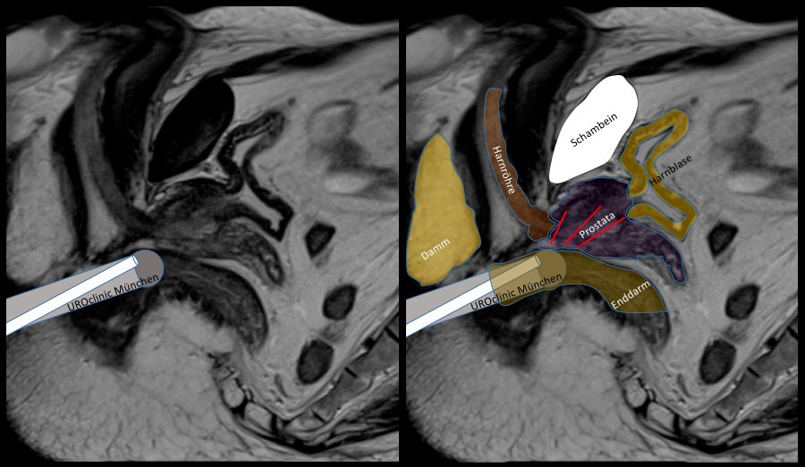 Fusionsbiopsie der Prostata München - Fusionsbiopsie Prostatakarzinom