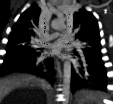 Hétérotaxie - Imagerie des malformations cardiaques
