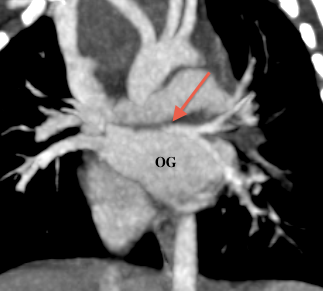 Anomalies des retours veineux pulmonaires - Imagerie des malformations ...