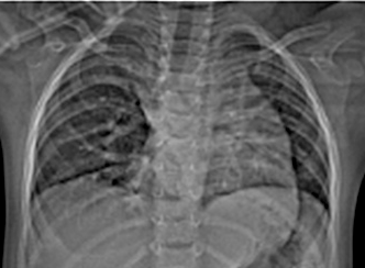 Artère pulmonaire gauche rétro-trachéale - Imagerie des malformations ...