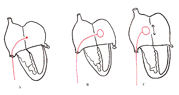 Transpositions des gros vaisseaux - Imagerie des malformations cardiaques