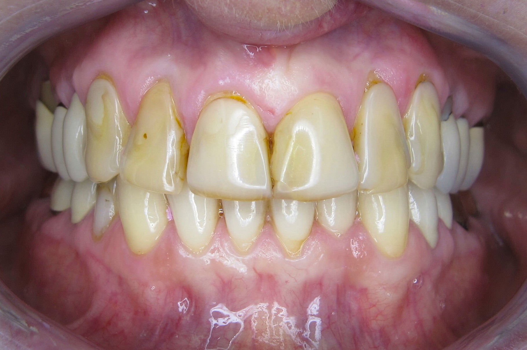 Facings - Ronald van der Linden Tandtechniek