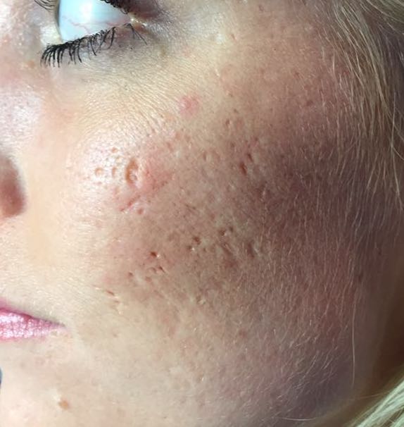 Narben behandeln, Chirurgie, Laser, Kälte! Hautarzt Linz - Dr. Barsch