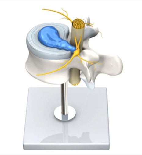 ESTENOSIS DE CANAL MEDULAR - ️ San Javier Fisioterapia