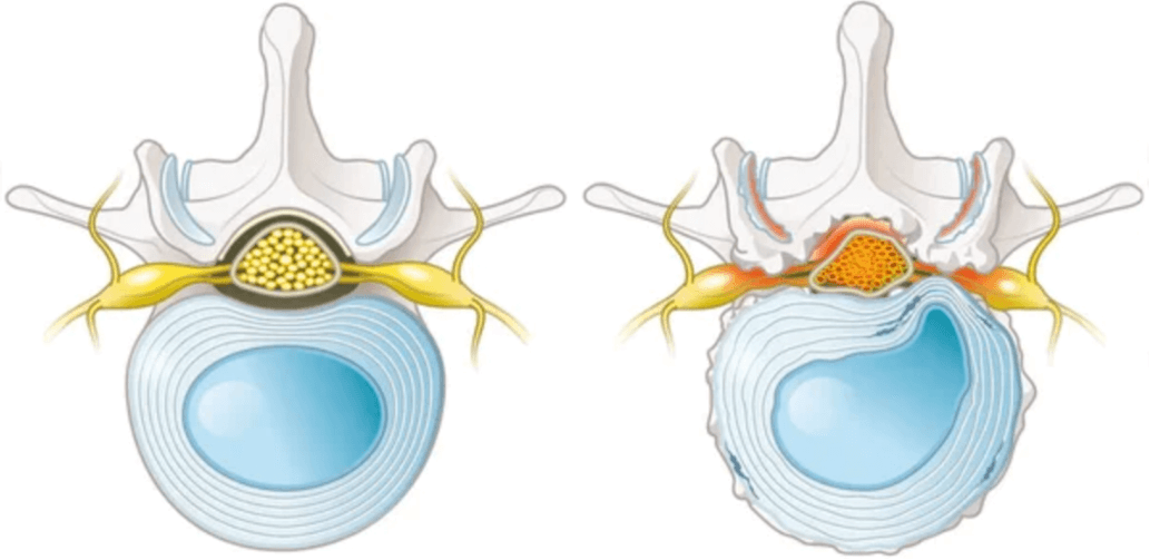 ESTENOSIS DE CANAL MEDULAR - ️ San Javier Fisioterapia