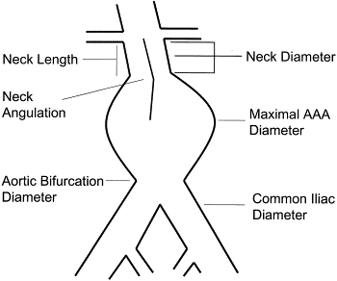 HP Case Prep: EVAR - Audible Bleeding: The Vascular Surgery Podcast
