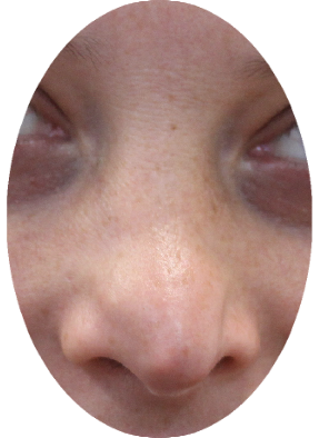 Revision Rhinoplasty Hamburg - Dr. Kovacevic