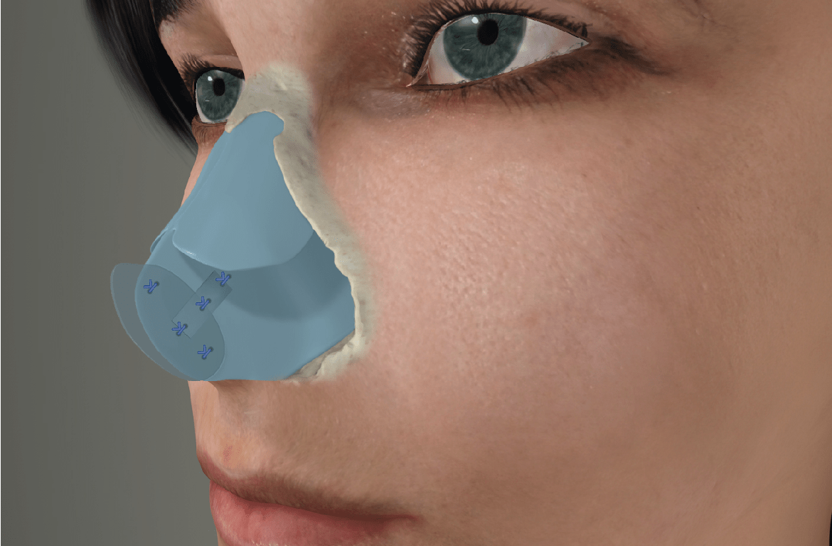 Nose tip correction Hamburg - Dr. Kovacevic