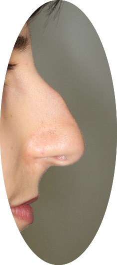 Info on different nose shapes - Dr. Kovacevic