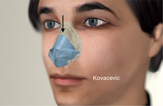 Push Down rhinoplasty Hamburg - Dr. Kovacevic