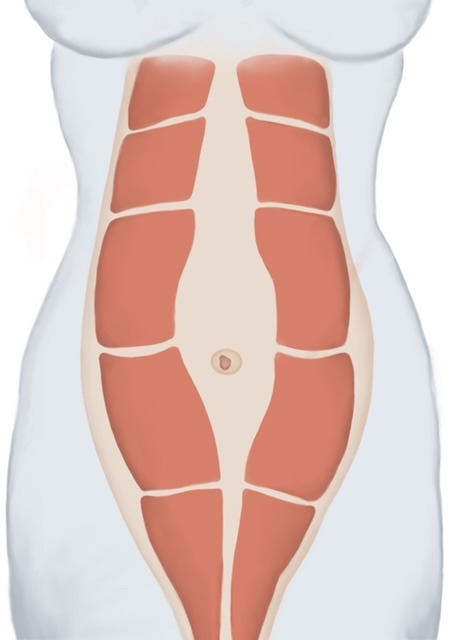 Rectus diastasis- Diagnostics, therapy and surgery - Hernienzentrum.Berlin