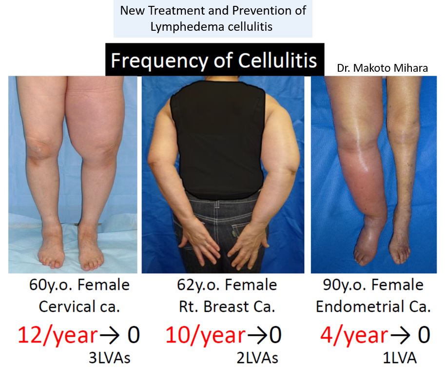 Cases, Cellulitis, Pain - Mominoki Day Surgery Clinic in Japan