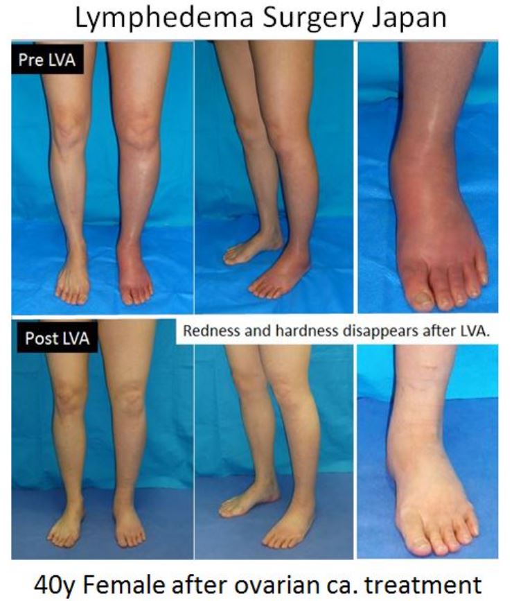 Cases, Cellulitis, Pain - Mominoki Day Surgery Clinic in Japan