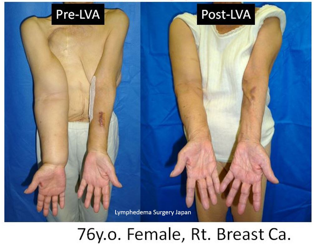 Cases, Cellulitis, Pain - Mominoki Day Surgery Clinic in Japan