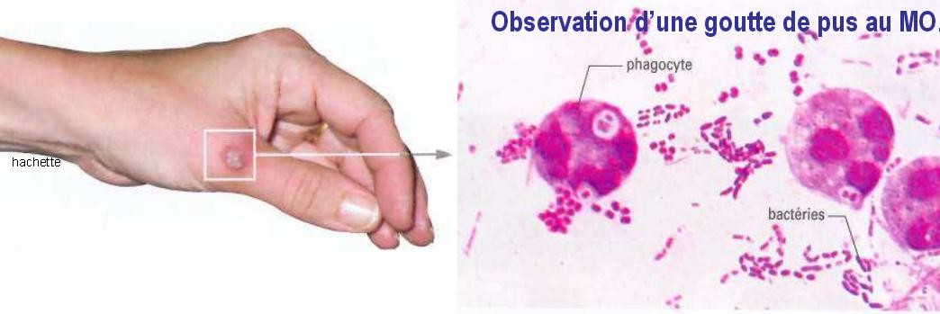 Les défenses immunitaires - Site de cours de collège et lycée en SVT