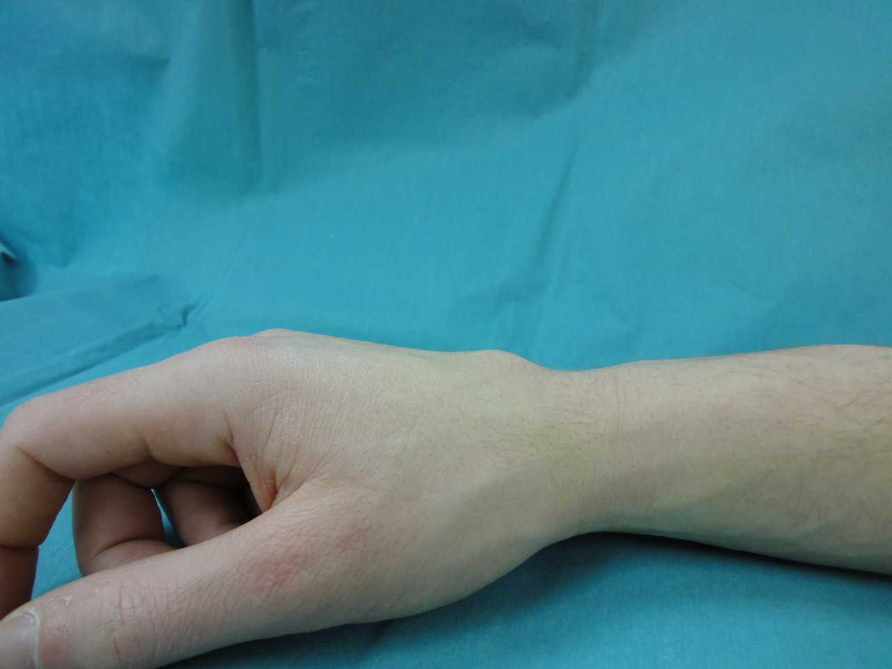 Carpe bossu - Orthohand.be
