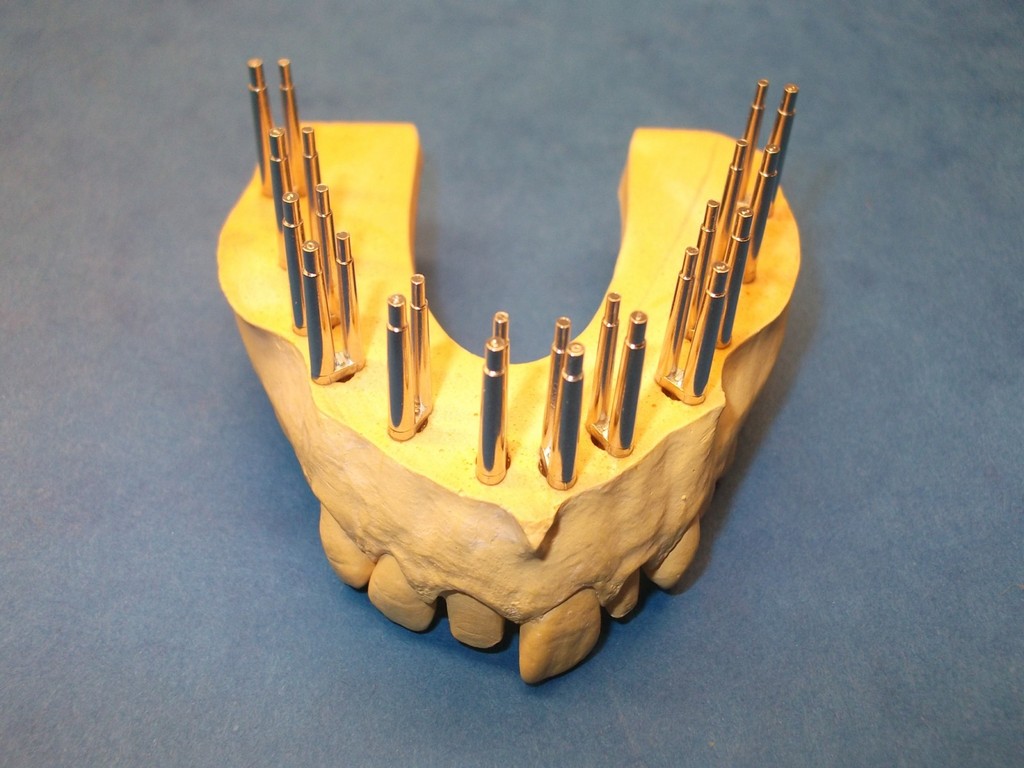 Individualización por pins - Apuntes de prótesis dental