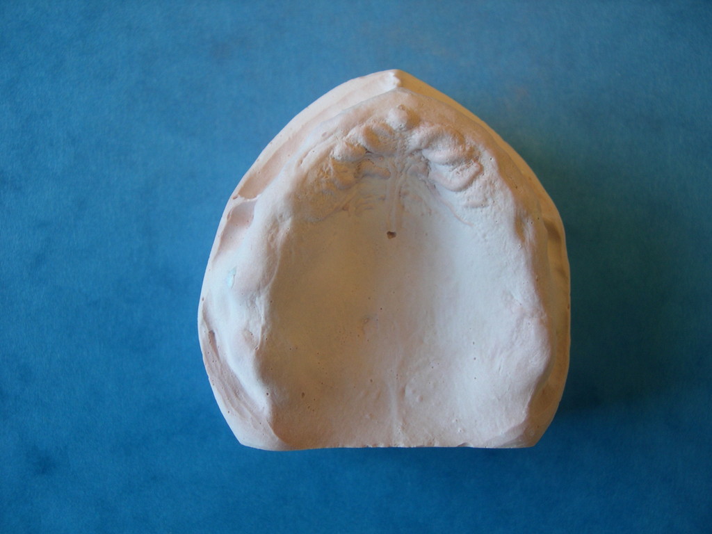 Modelo superior - Apuntes de prótesis dental