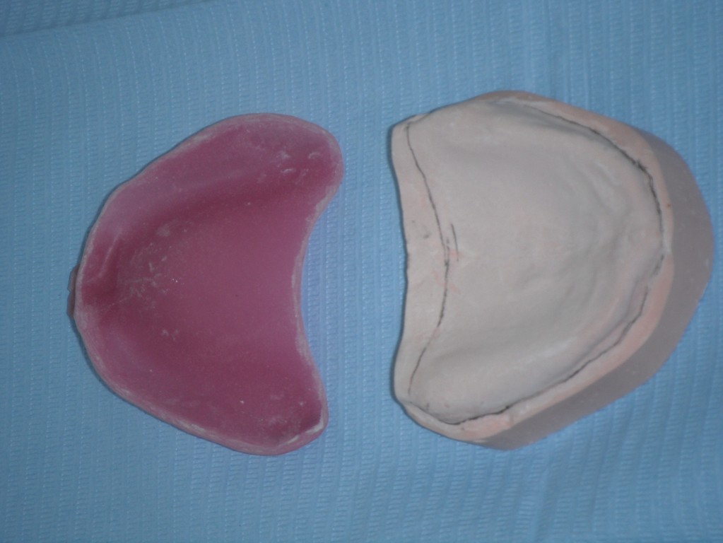 Impresiones definitivas - Apuntes de prótesis dental