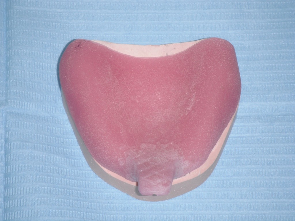 Impresiones definitivas - Apuntes de prótesis dental