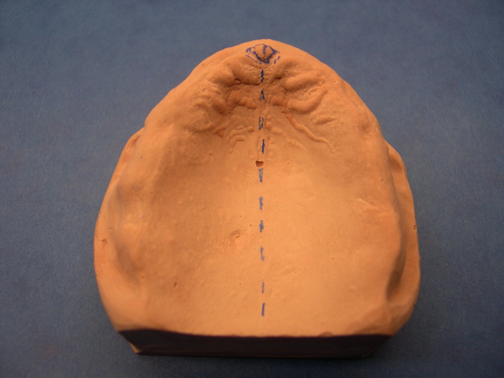 Modelo superior - Apuntes de prótesis dental