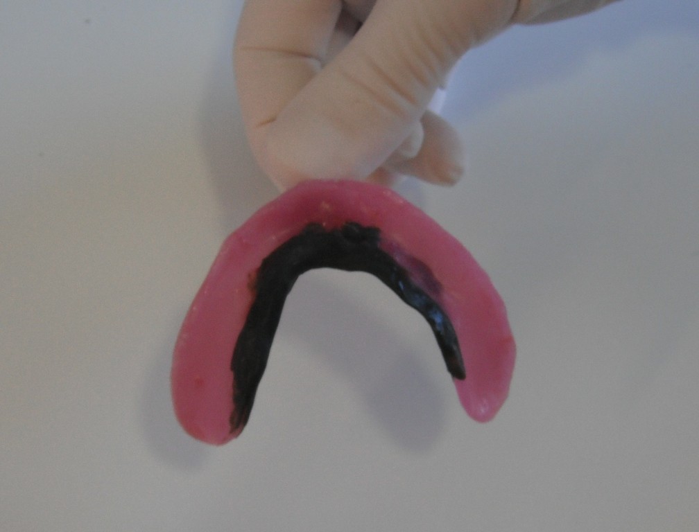 Impresiones definitivas - Apuntes de prótesis dental