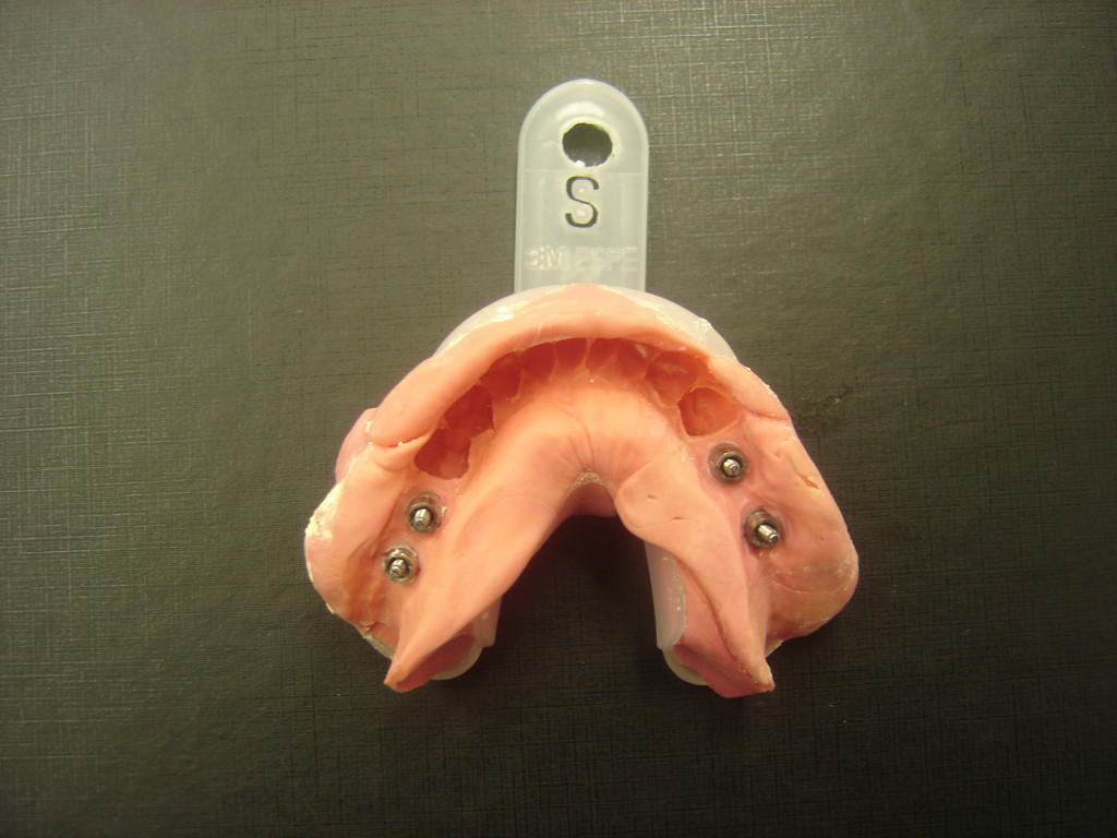Vaciado de modelos de implantes - Apuntes de prótesis dental