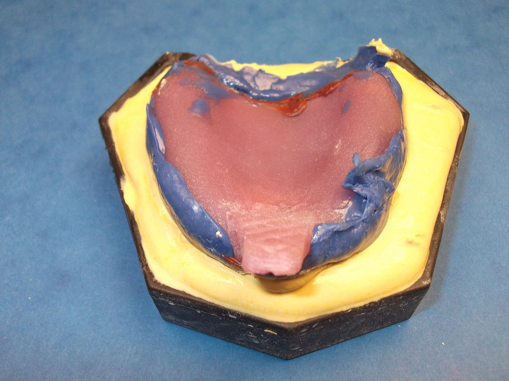 Impresiones definitivas - Apuntes de prótesis dental