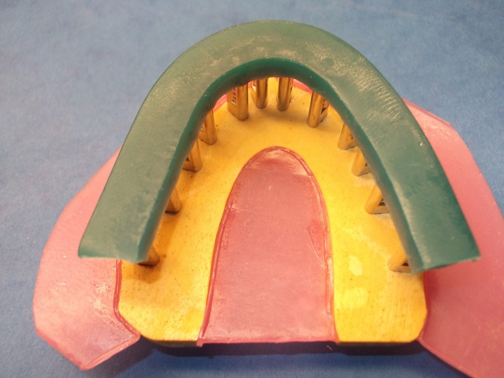 Individualización por pins - Apuntes de prótesis dental