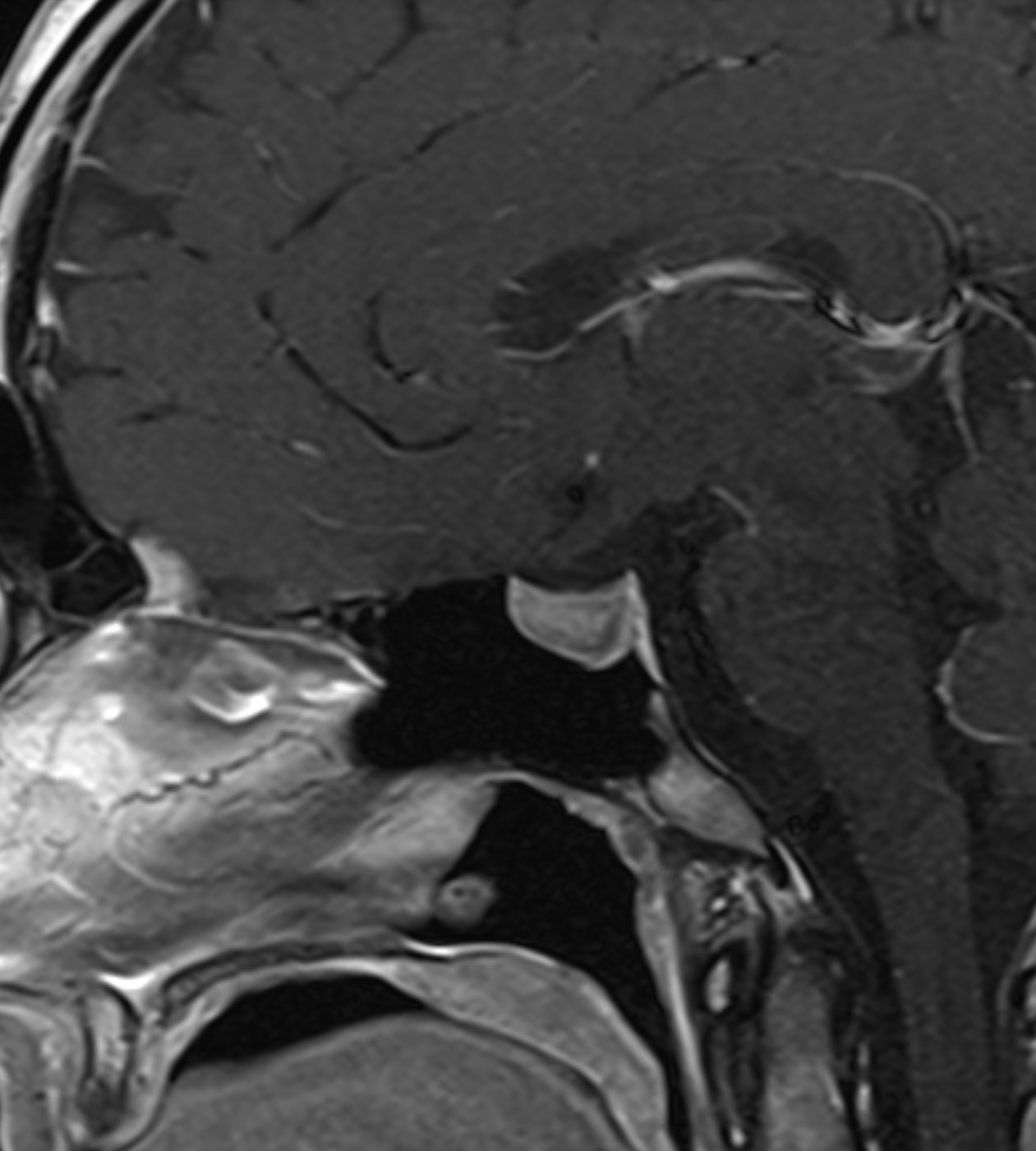 Was ist ein Prolaktinom? - nervenchaoss Webseite!