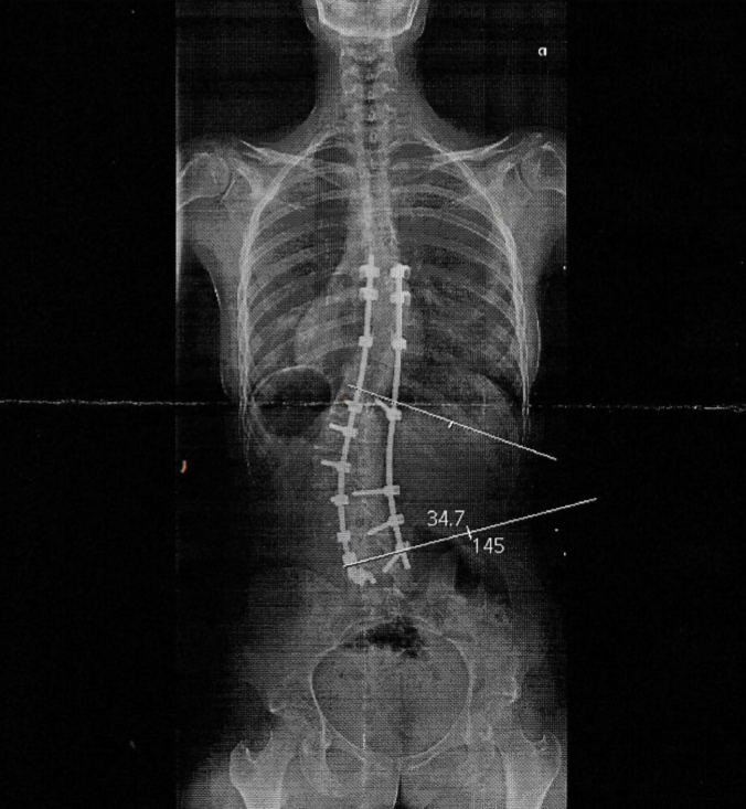 Qu'est-ce que la scoliose idiopathique tridirectionnelle? - Site de ...