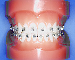 Types of Orthodontic Device - CS Orthodontic Clinic | Shibuya Tokyo