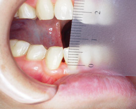 Dental Hyaluronic Acid Treatment - CS Orthodontic Clinic | Shibuya Tokyo