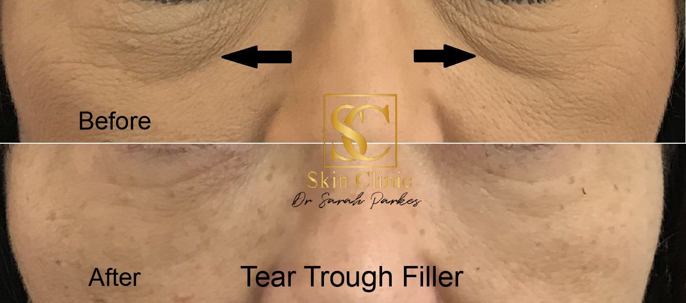 Tear Trough filler injections - Skin Clinic