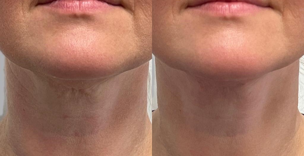 PDO Thread Lift - Skin Clinic