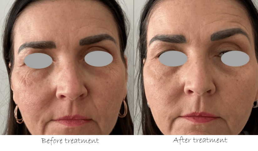 Polynucleotide treatment - Skin Clinic