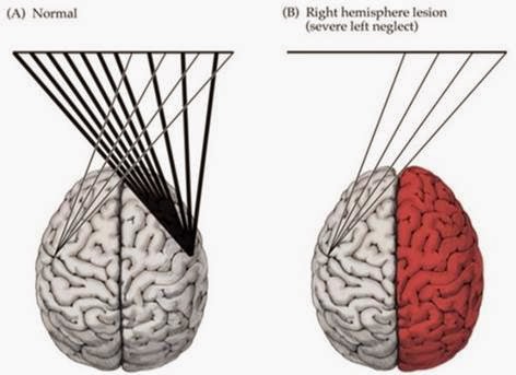¿QUÉ ES LA HEMINEGLIGENCIA? - estimulacioncognitiva