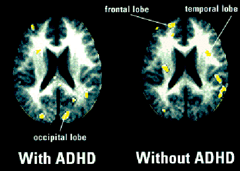 Neuroimagen en el diagnóstico del TDAH - Neuropsicólogo Ulises Espino ...