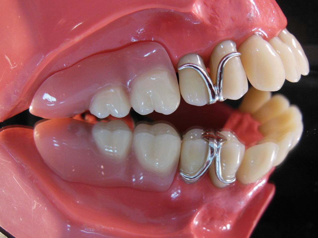 Modellguss-Prothesen - Dentallabor Frank Reinhard GmbH - Saarland CAD - CAD