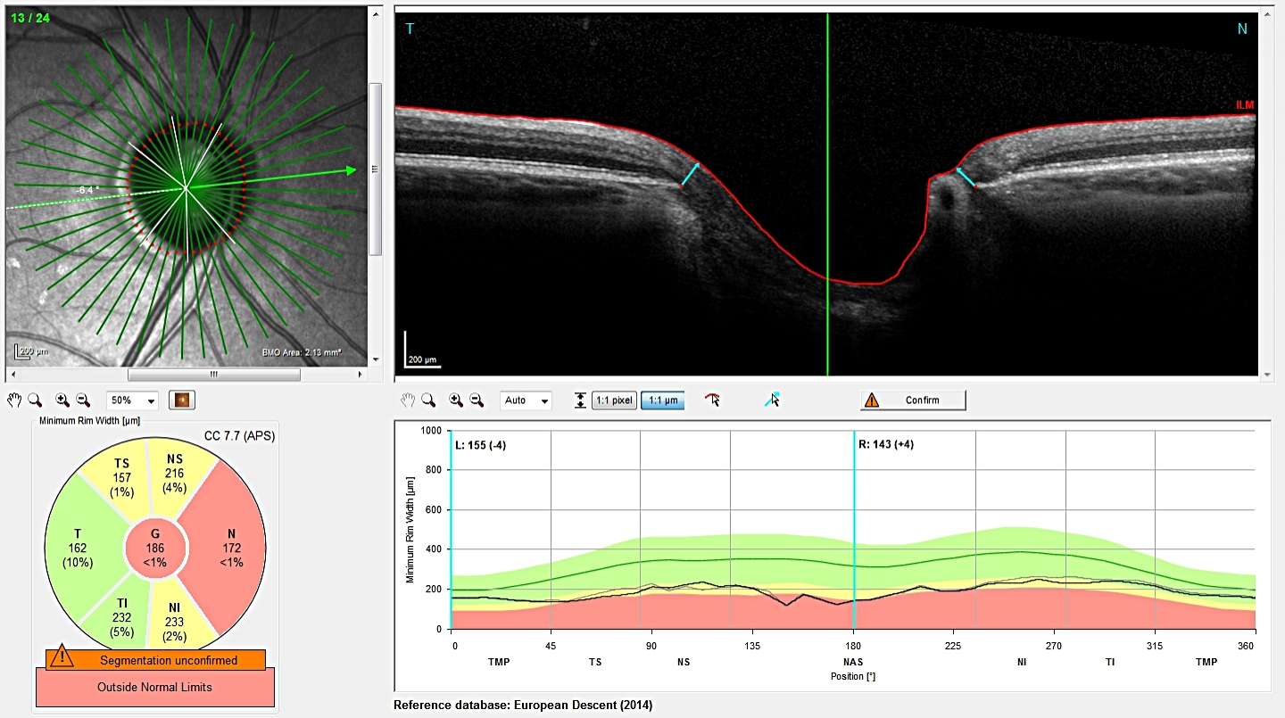 Glaucome - Docteur Deneyer Ophtalmologue chirurgie réfractive et cataracte