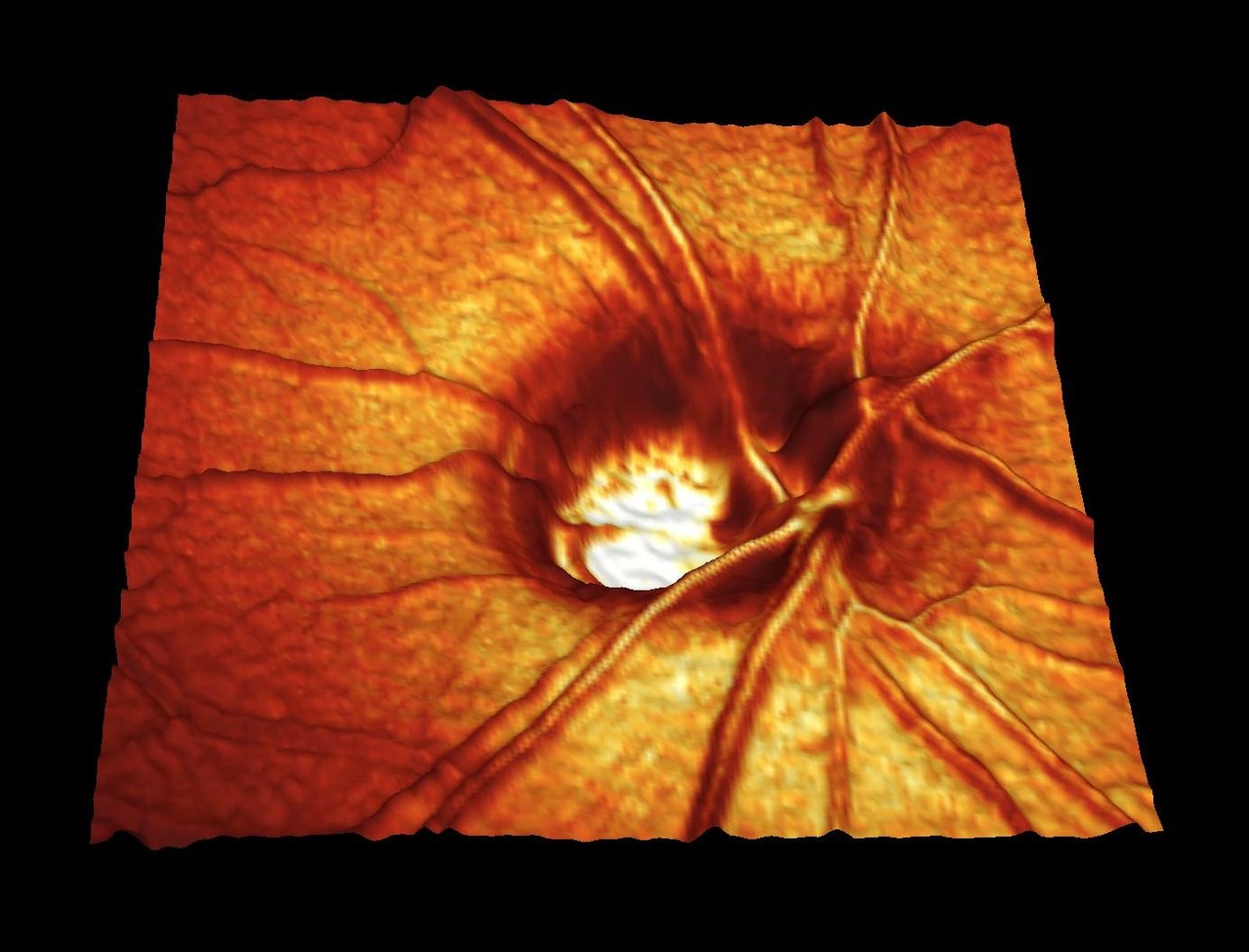 HRT Heidelberger Retina Tomographie - Augenärzte Papst Hamburg
