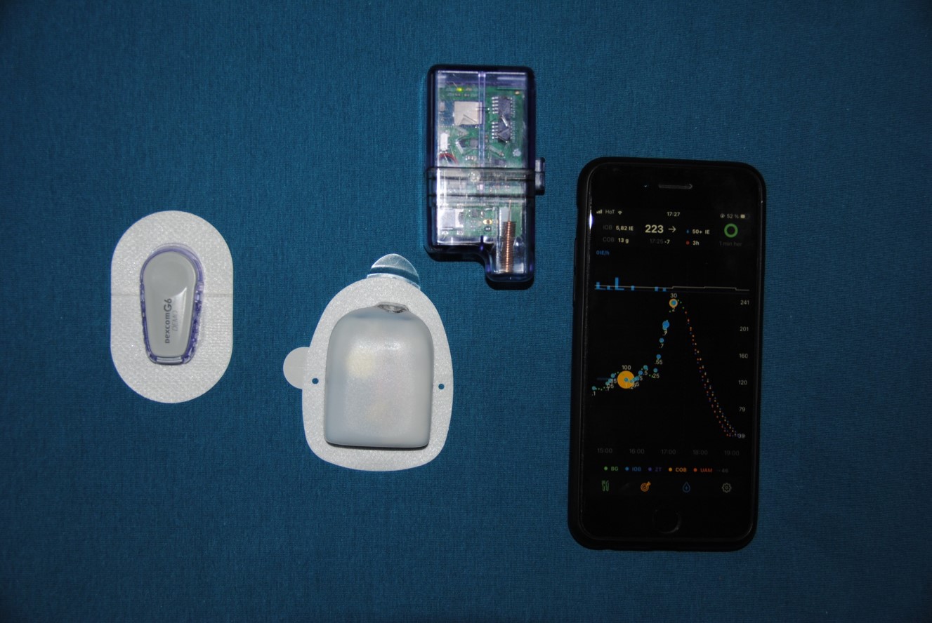 Hybrid closed Loop Systems- Automated Insulin Delivery (AID) - diabetes ...